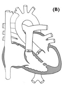 Ventricular Septal Defect (VSD) : ~~~~~~ Abigail Maja