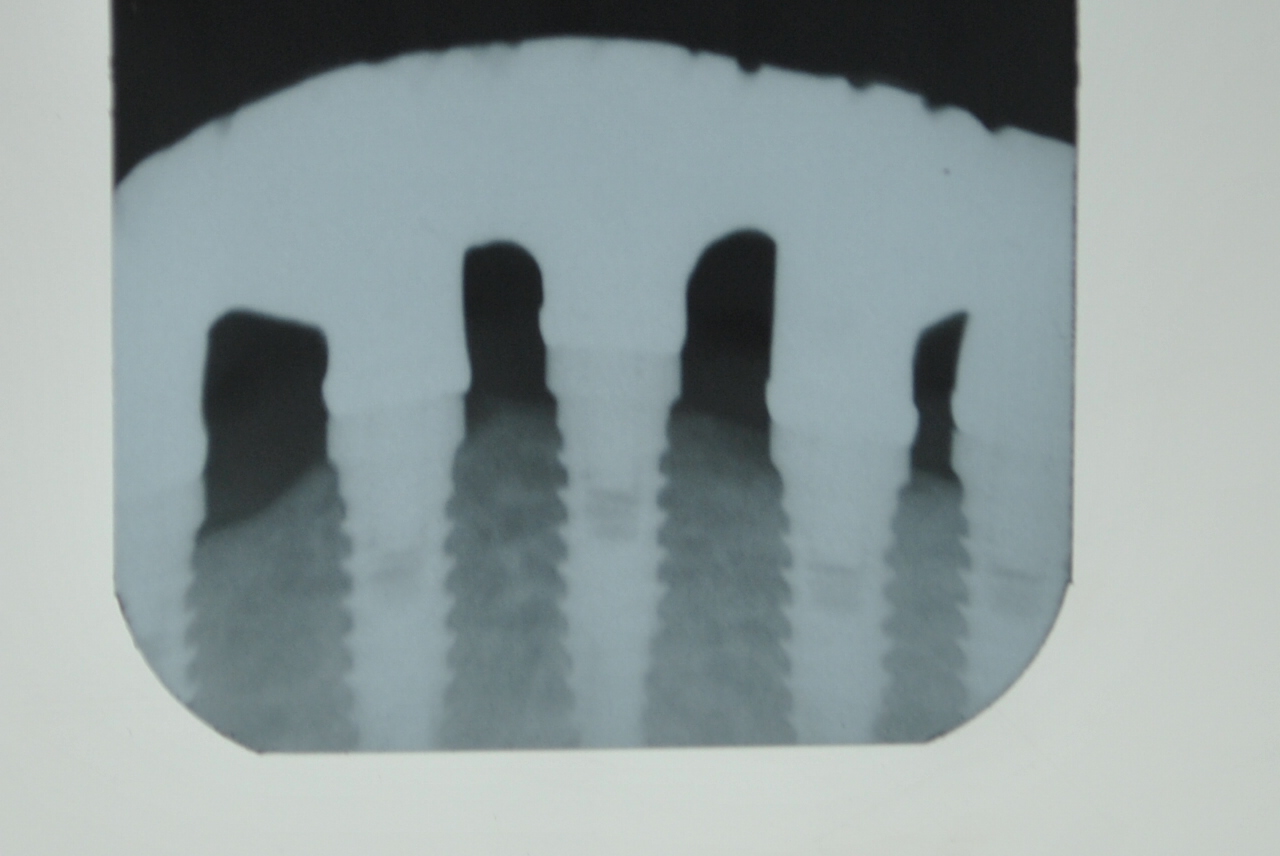 Especialistas em Prótese sobre Implante - CAD: Barra de protocolo sem solda