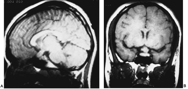 ON - RADIOLOGY: Optic nerve glioma; the most common cause of optic ...