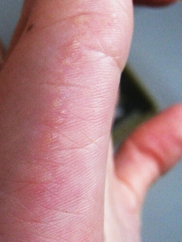 Scabies On Hands